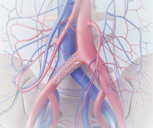 R2P Misago | 医療機器 | テルモメディカルナビ