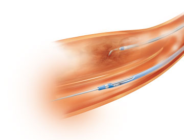 Navifocus WR | 医療機器 | テルモメディカルナビ