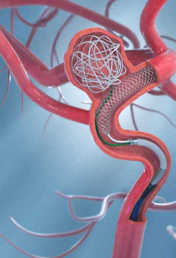 LVIS / LVIS Jr. | 医療機器 | テルモメディカルナビ